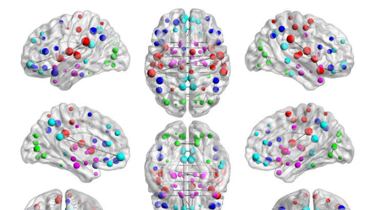 Brain Networks in Focal Epilepsy | King's College Epilepsy